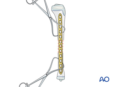 Open reduction - Plate fixation for Simple transverse tibial fracture