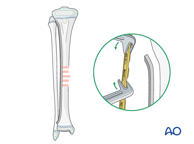 Open reduction - Plate fixation for Simple transverse tibial fracture