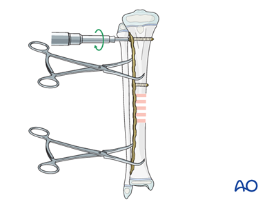 Open reduction - Plate fixation for Simple transverse tibial fracture