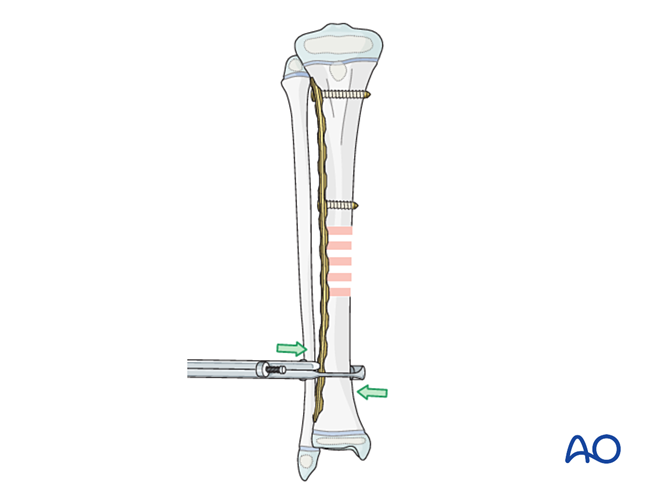 Open reduction - Plate fixation for Simple transverse tibial fracture
