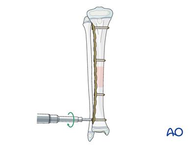 Open reduction - Plate fixation for Simple transverse tibial fracture