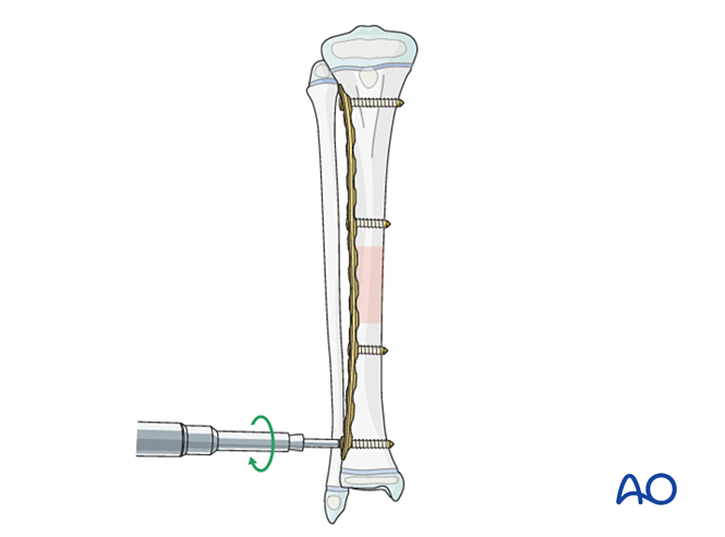 Open reduction - Plate fixation for Simple transverse tibial fracture