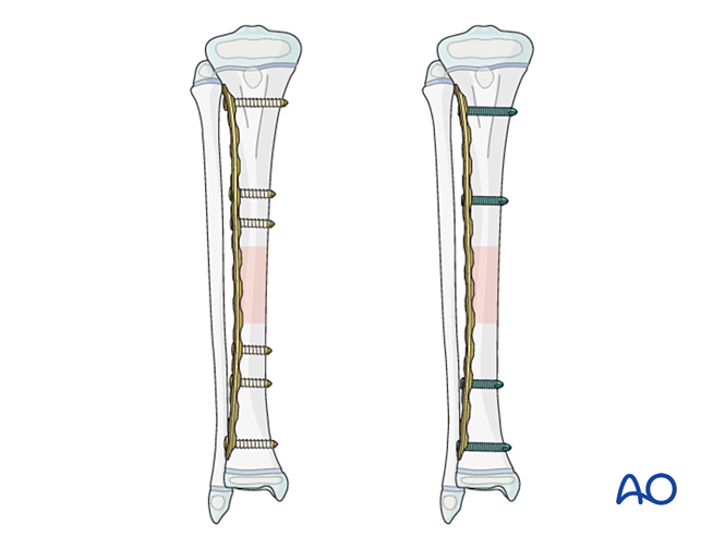 Open reduction - Plate fixation for Simple transverse tibial fracture