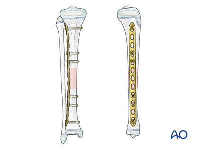 Open reduction - Plate fixation for Simple transverse tibial fracture