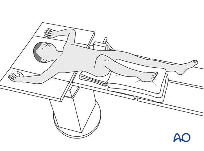 Open reduction - Plate fixation for Simple transverse tibial fracture