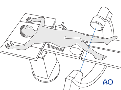 Patient preparation in supine position