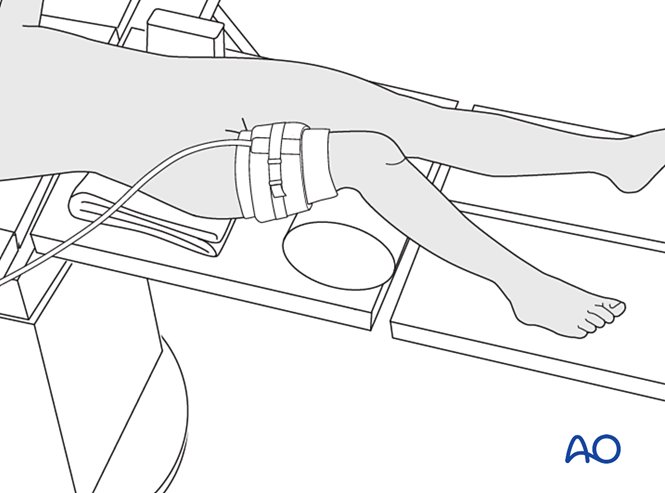 Patient preparation in supine position