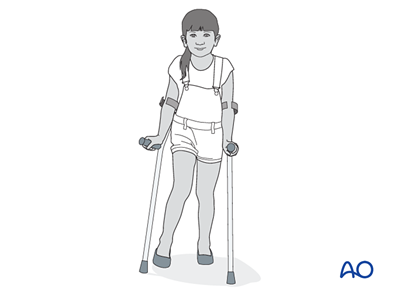 Open reduction - Plate fixation for Simple transverse tibial fracture