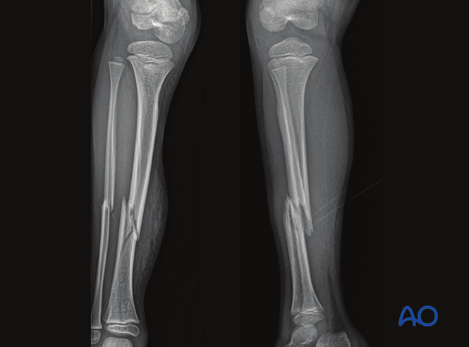 All further reading for the management of the pediatric tibial shaft