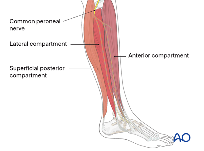 Compartment syndrome (lower limb)