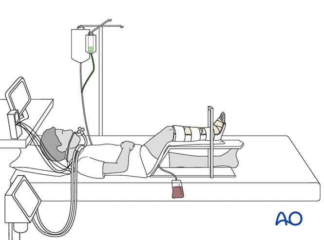 Compartment syndrome (lower limb)