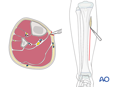 Compartment syndrome (lower limb)