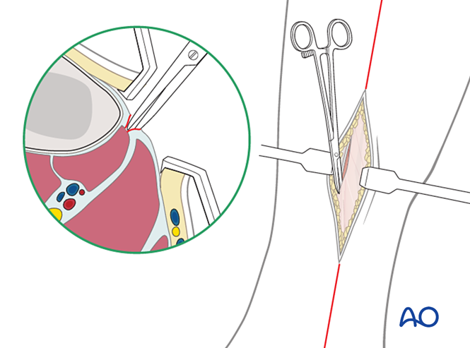 Compartment syndrome (lower limb)