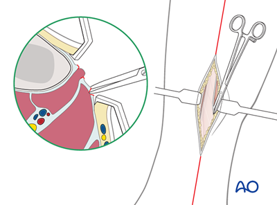 Compartment syndrome (lower limb)