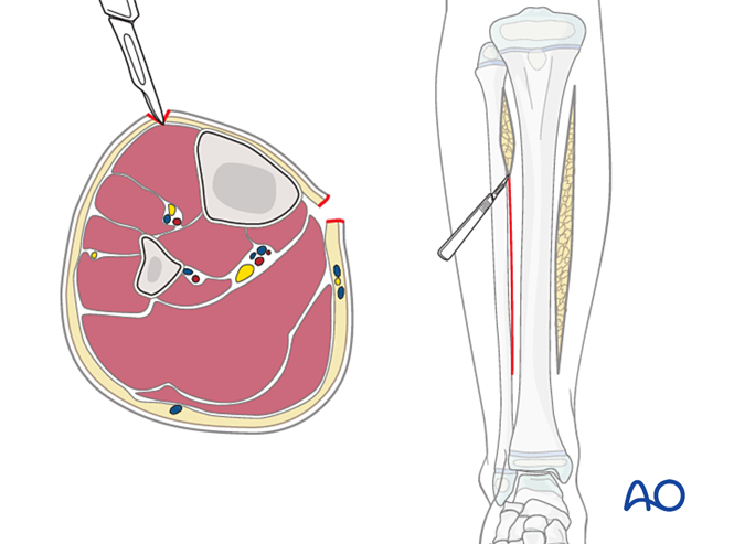 Compartment syndrome (lower limb)