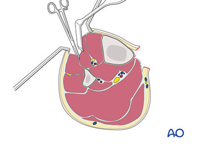 Compartment syndrome (lower limb)
