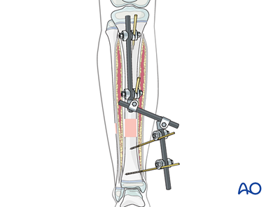 Compartment syndrome (lower limb)