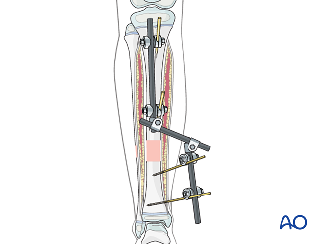 Compartment syndrome (lower limb)