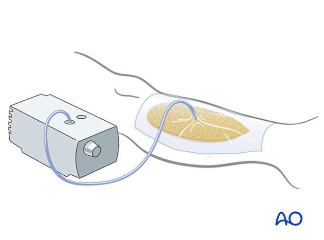 Compartment syndrome (lower limb)