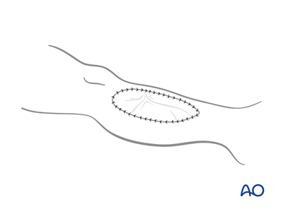 Compartment syndrome (lower limb)