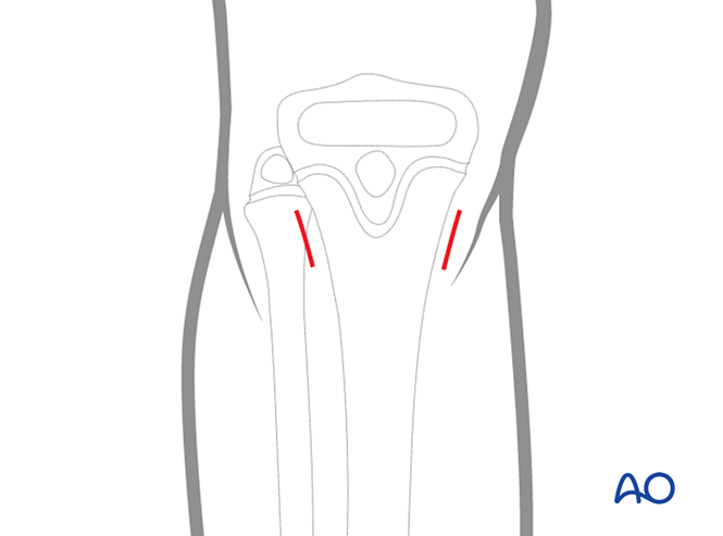 Elastic nailing for Simple complete fracture of the distal tibial ...