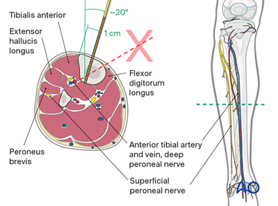 Safe zones for pin placement in the pediatric leg