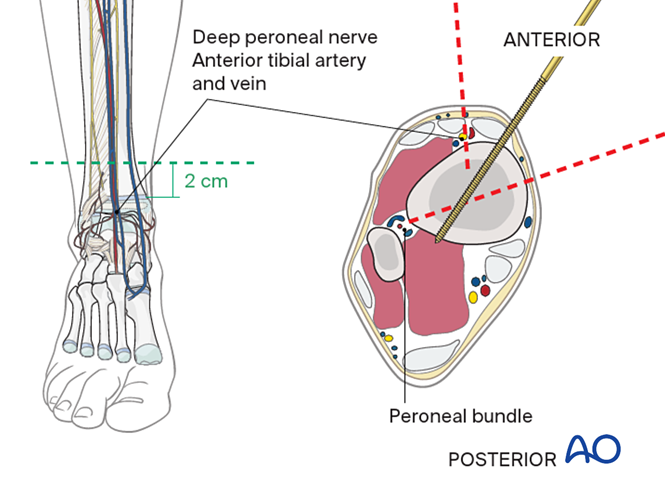 Safe zones for pin placement in the pediatric leg