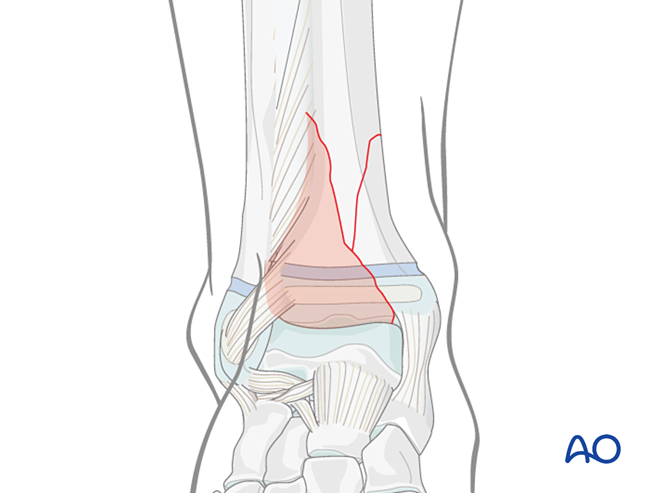 Anterolateral approach to the pediatric distal tibia