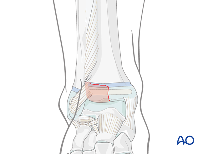 Anterolateral approach to the pediatric distal tibia