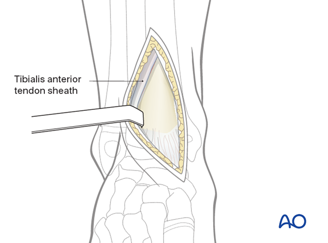 Anteromedial approach to the pediatric distal tibia