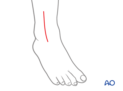 Anterolateral approach to the pediatric distal tibia