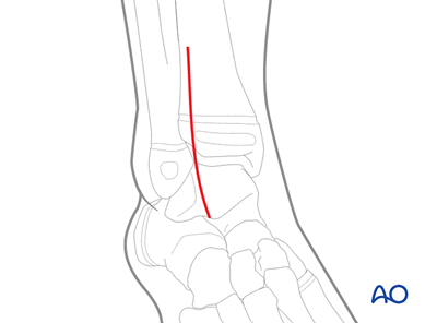 Anterolateral approach to the pediatric distal tibia