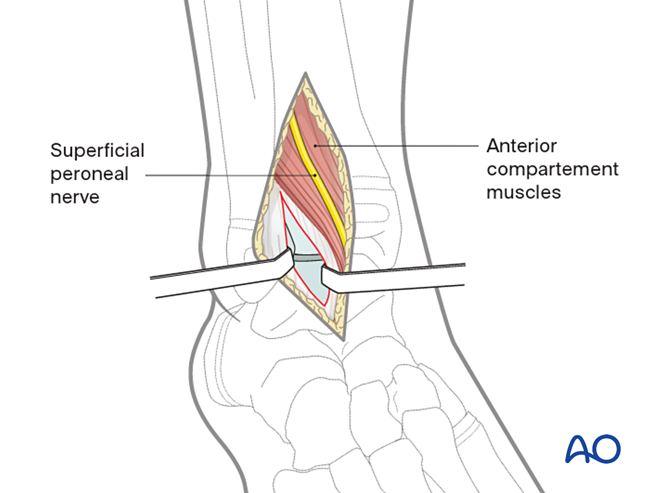 Open Reduction Screw Fixation For Complex Epi Metaphyseal Fractures Of The Distal Tibia Triplane