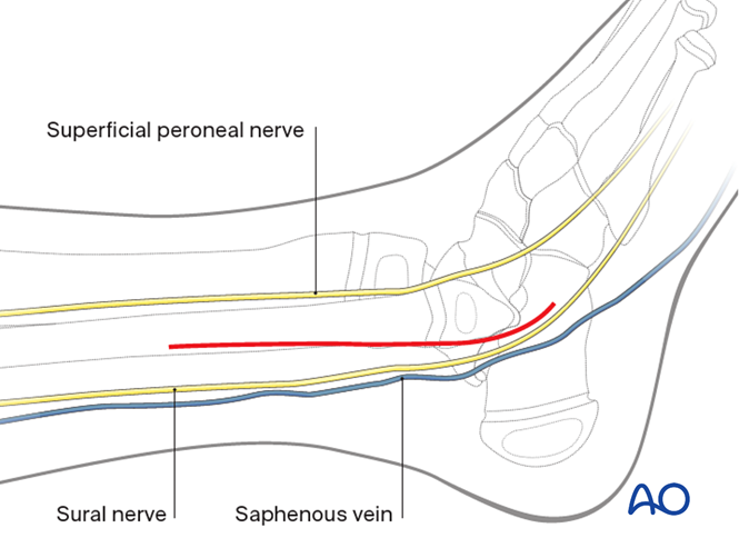 Lateral approach to the pediatric distal fibula