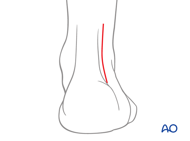 All approaches to the pediatric distal tibia and fibula