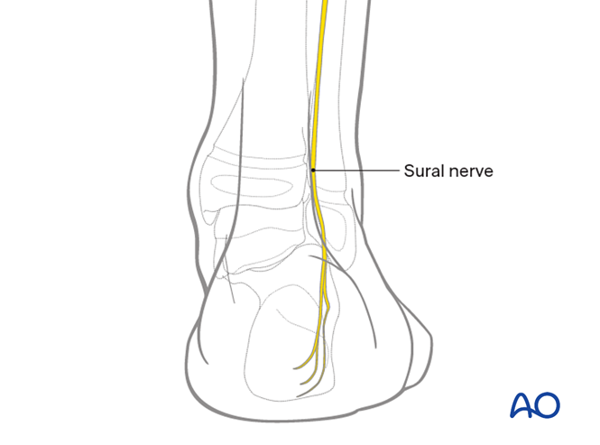Posterolateral approach to the pediatric distal tibia