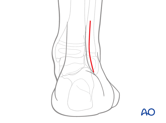 Posterolateral approach to the pediatric distal tibia