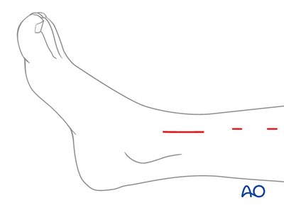 All approaches to the pediatric distal tibia and fibula