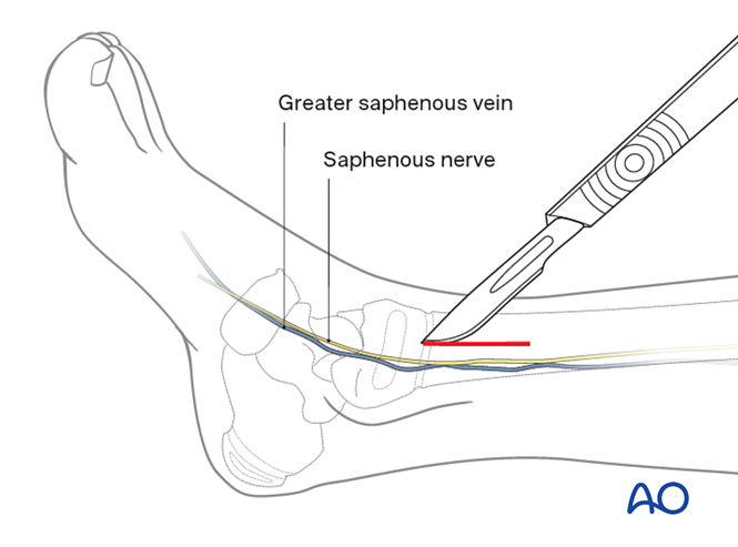 Minimally invasive approach to the pediatric distal tibia