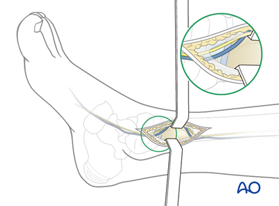 Minimally invasive approach to the pediatric distal tibia