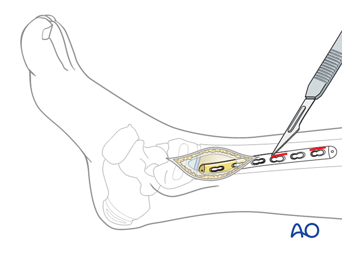 Minimally invasive approach to the pediatric distal tibia