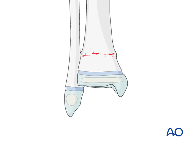 Torus/buckle fracture of the distal tibial metaphysis