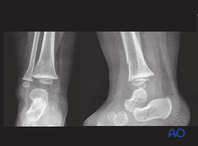 Torus/buckle fracture of the distal tibial metaphysis