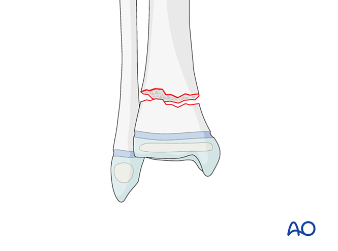 Simple complete fracture of the distal tibial metaphysis