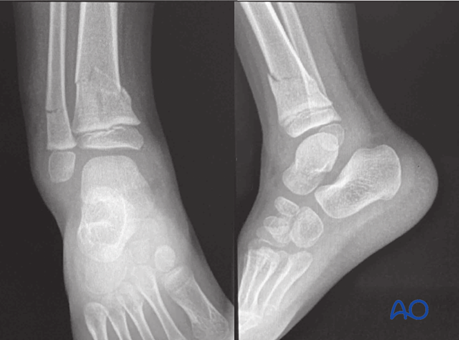 Simple complete fracture of the distal tibial metaphysis