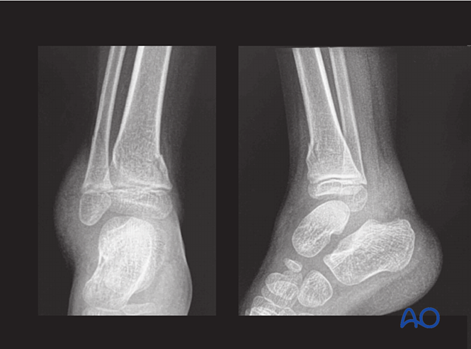 Multifragmentary complete fracture of the distal tibial metaphysis