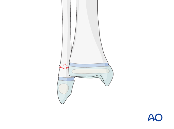 Torus/buckle fracture of the distal fibular metaphysis