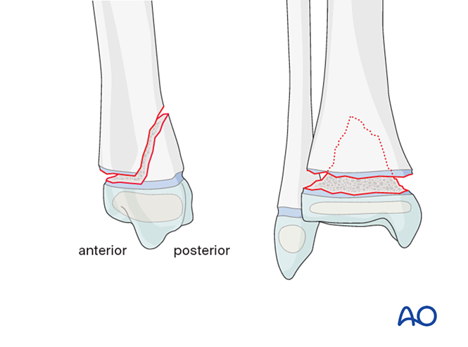 Epiphysiolysis with metaphyseal wedge (Salter-Harris II) of the distal ...