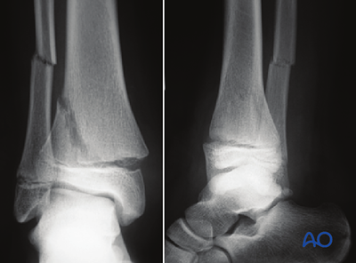 Epiphysiolysis with metaphyseal wedge (Salter-Harris II) of the distal ...