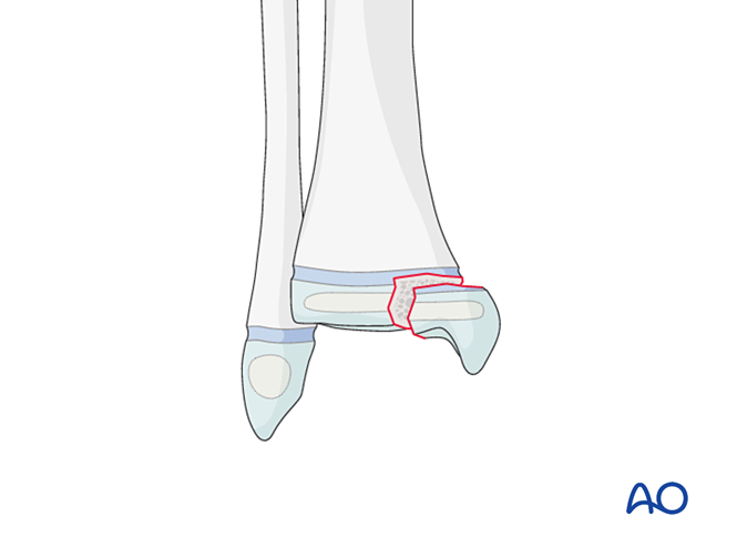 Epiphyseal fractures (Salter-Harris III) of the distal tibia